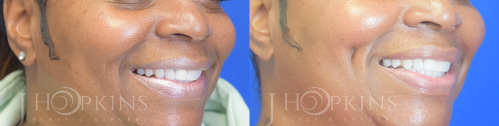 Dimple Creation Before & After Photos | Dr. Jeffrey Hopkins